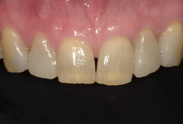 Experience Japan’s only non-drilling cosmetic dental treatment in Asia.