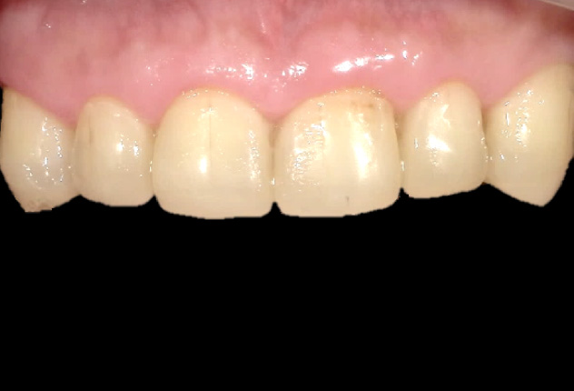 Experience Japan’s only non-drilling cosmetic dental treatment in Asia.